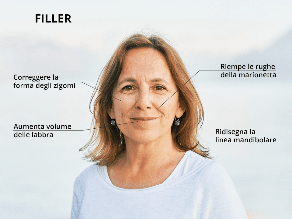 Perioral Filler - Dentista Bari Studio Odontoiatrico Di Gioia